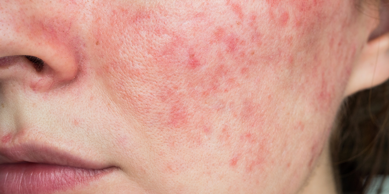 Managing Redness and Irritation From Rosacea: A Guide — Graydon Skincare